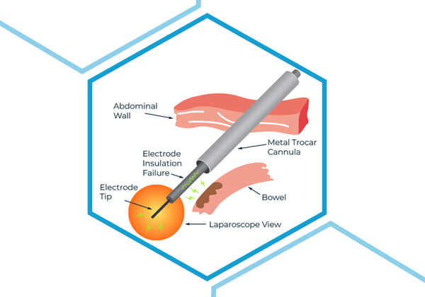 Causes of Laparoscopic Sheath Insulation Failure – jenseninstruments